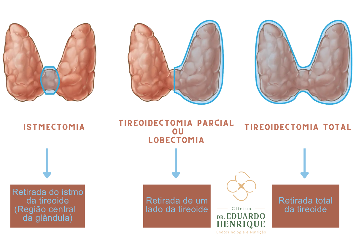 Seguimento do Paciente Pós Tireoidectomia: uma Abordagem Integral