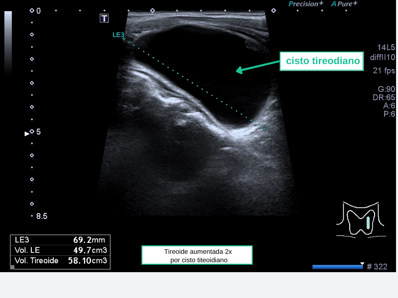 Bócio: entenda as causas e saiba como tratar