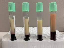 Triglicerídeos alto: o que fazer para baixar