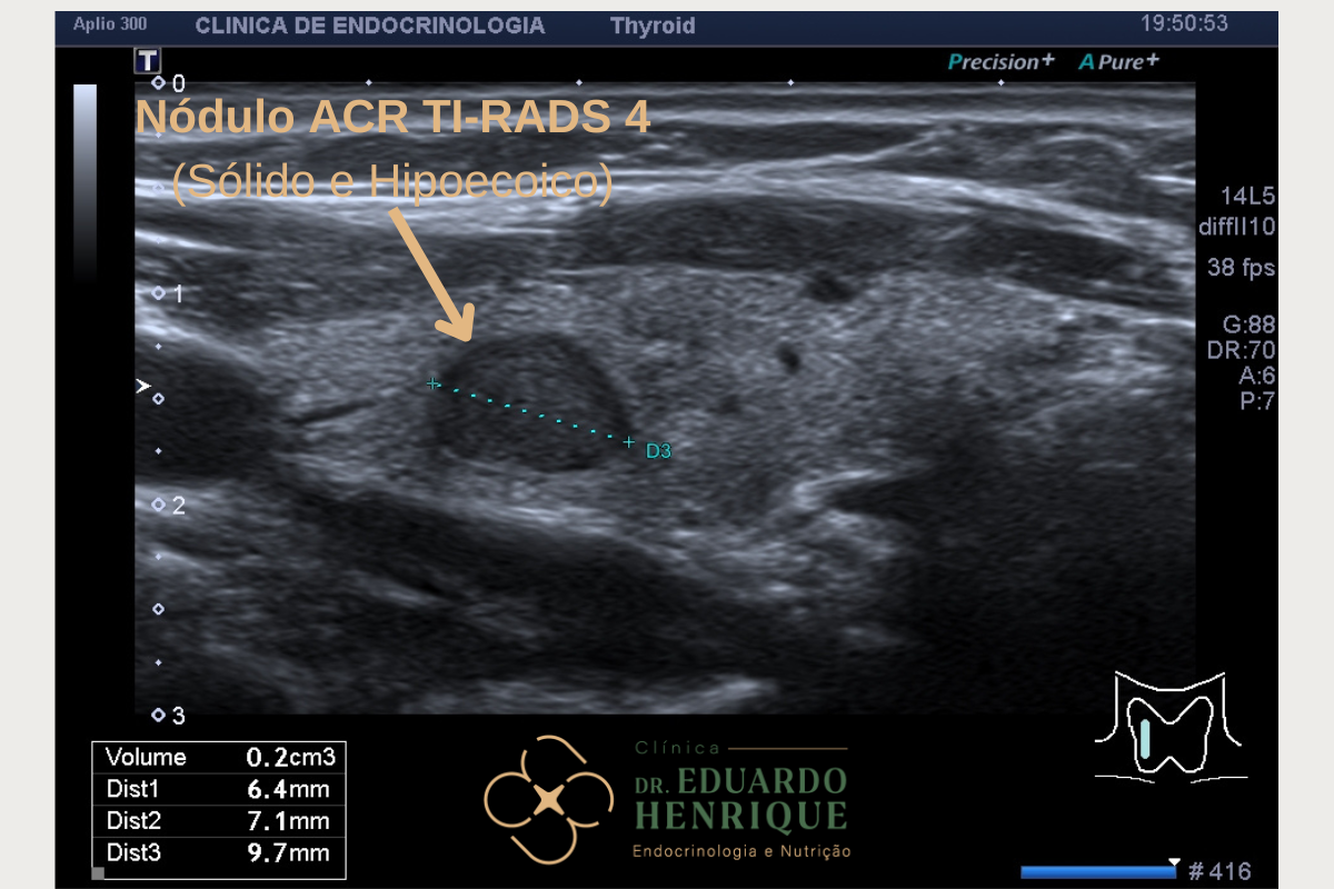 Especialista em Nódulo da Tireoide TIRADS 4 em São Paulo