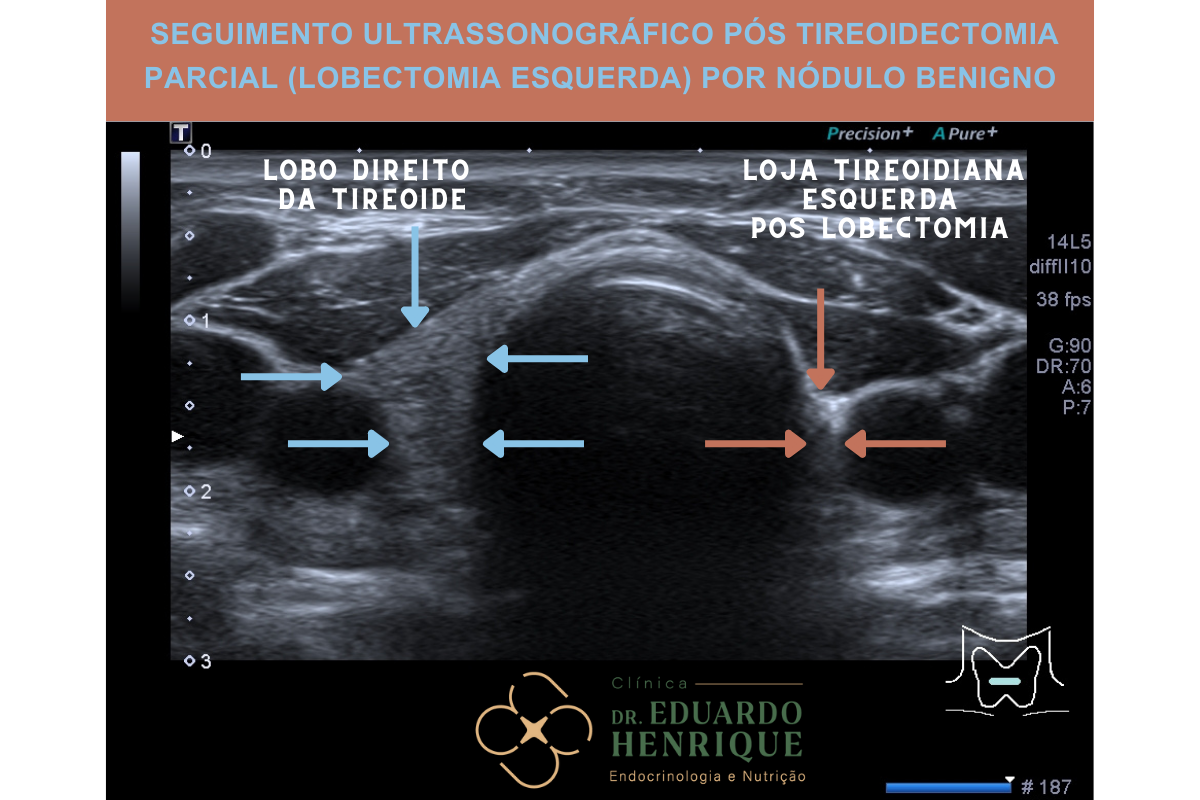 Seguimento do Paciente Pós Tireoidectomia: uma Abordagem Integral