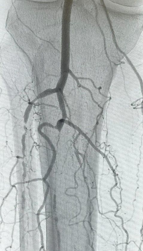 Vascular Medicare Tucson, AZ | Arizona Endovascular Center
