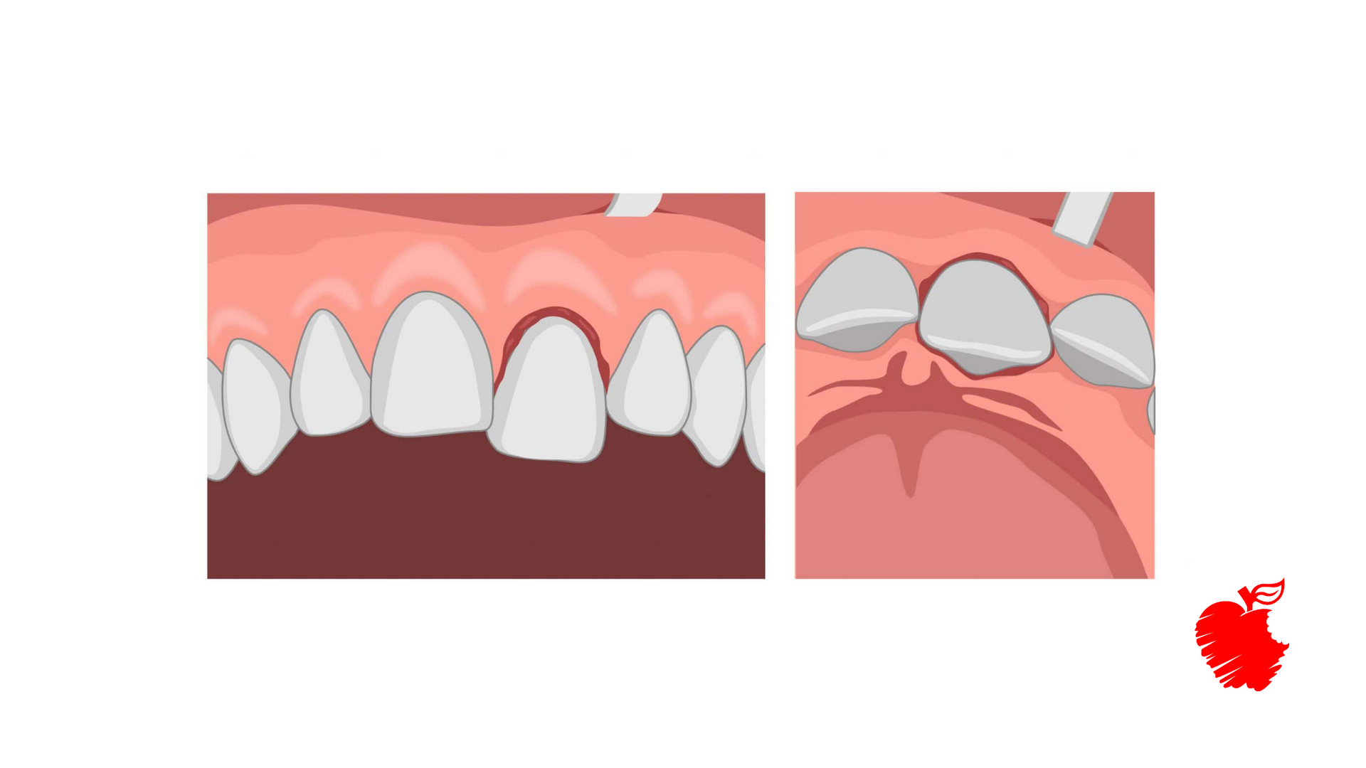 Tooth Luxation: Types, Causes, Symptoms, and Treatment