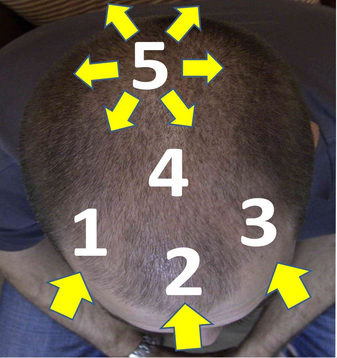 Best hair regrowth treatments for men regrowth products