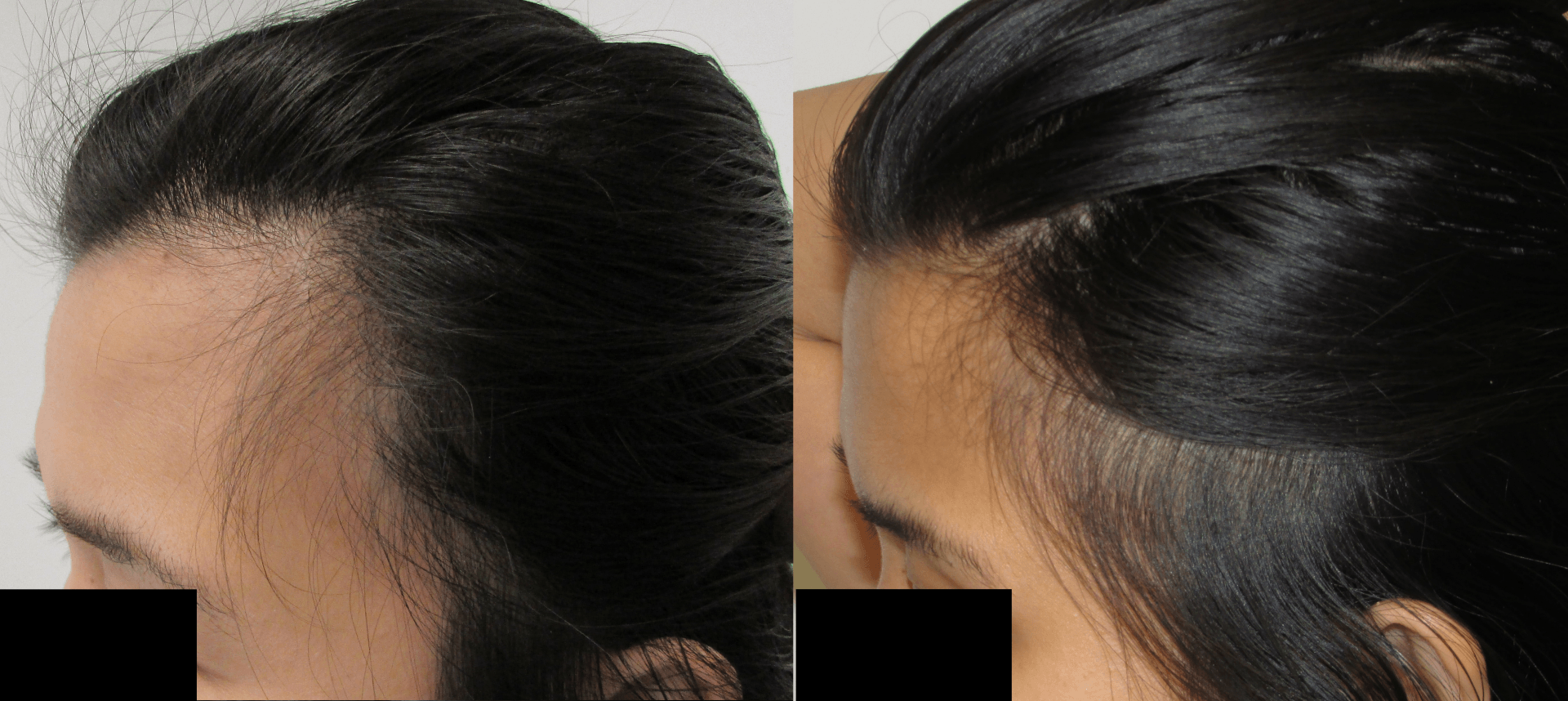 Female Hair Regrowth Reviews