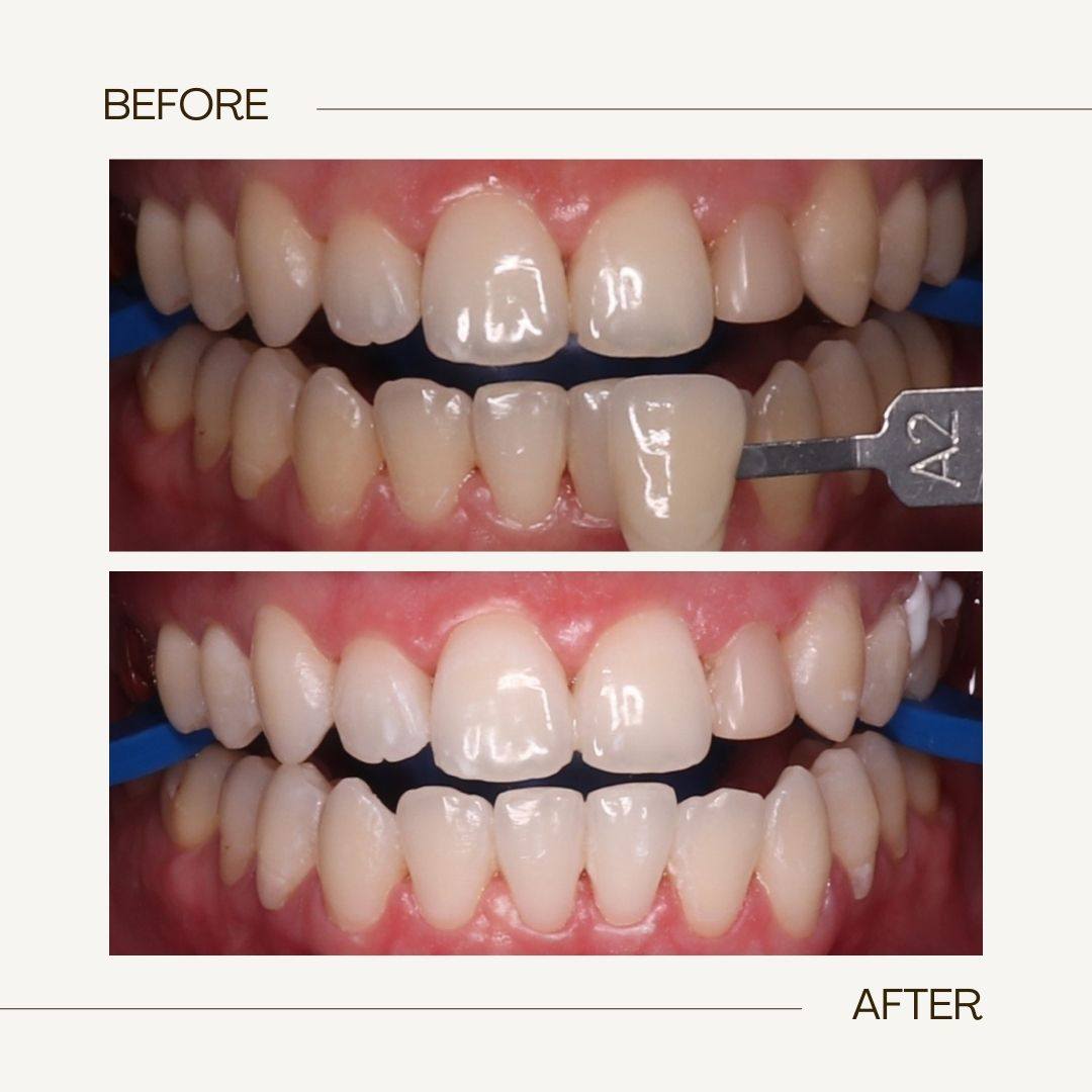 Effective Tooth Whitening System in NSW | Port Smiles Dental