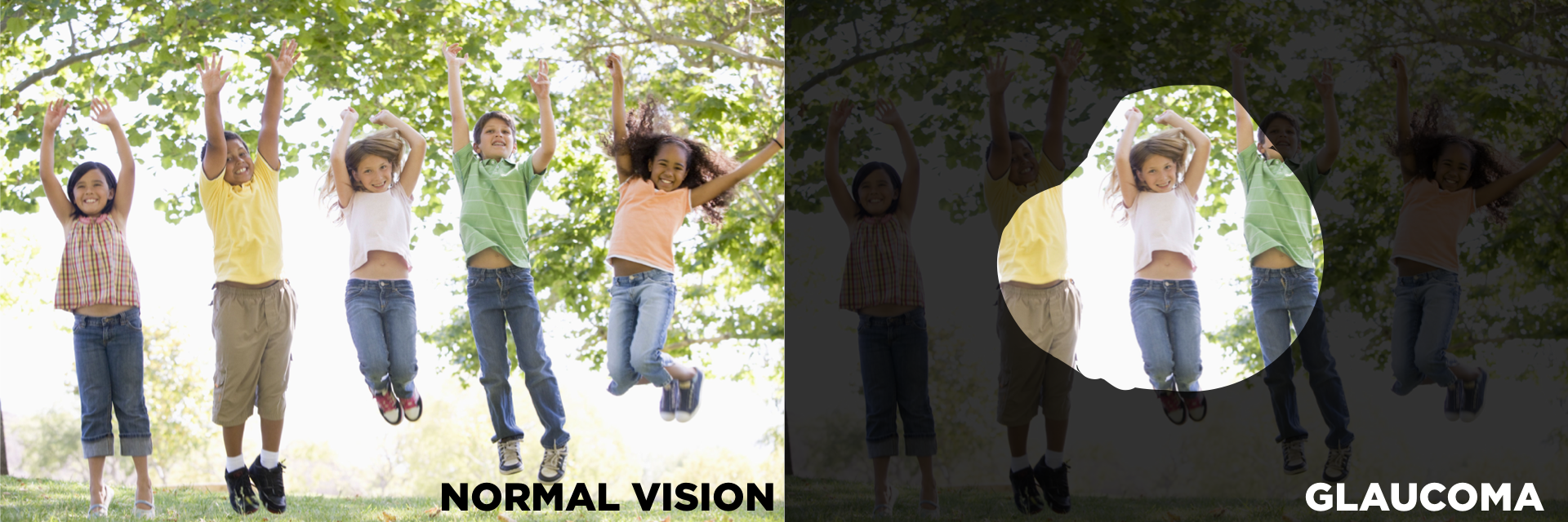 Glaucoma Diagnosis and Treatment| Blake Bush Family Eye Care