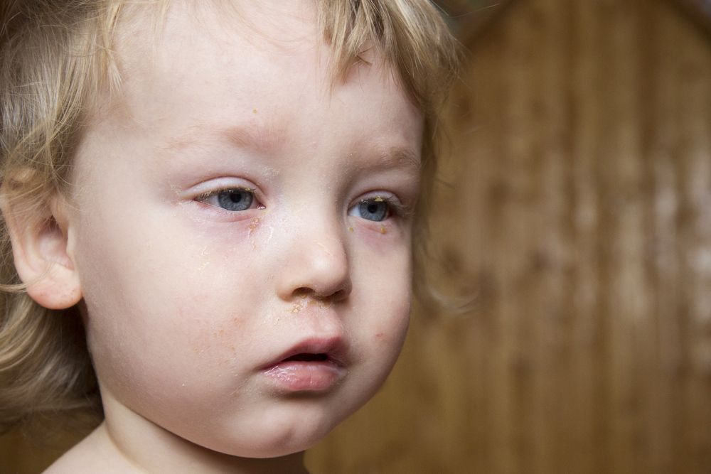 Understanding Pink Eye :Symptoms, Causes and Treatment