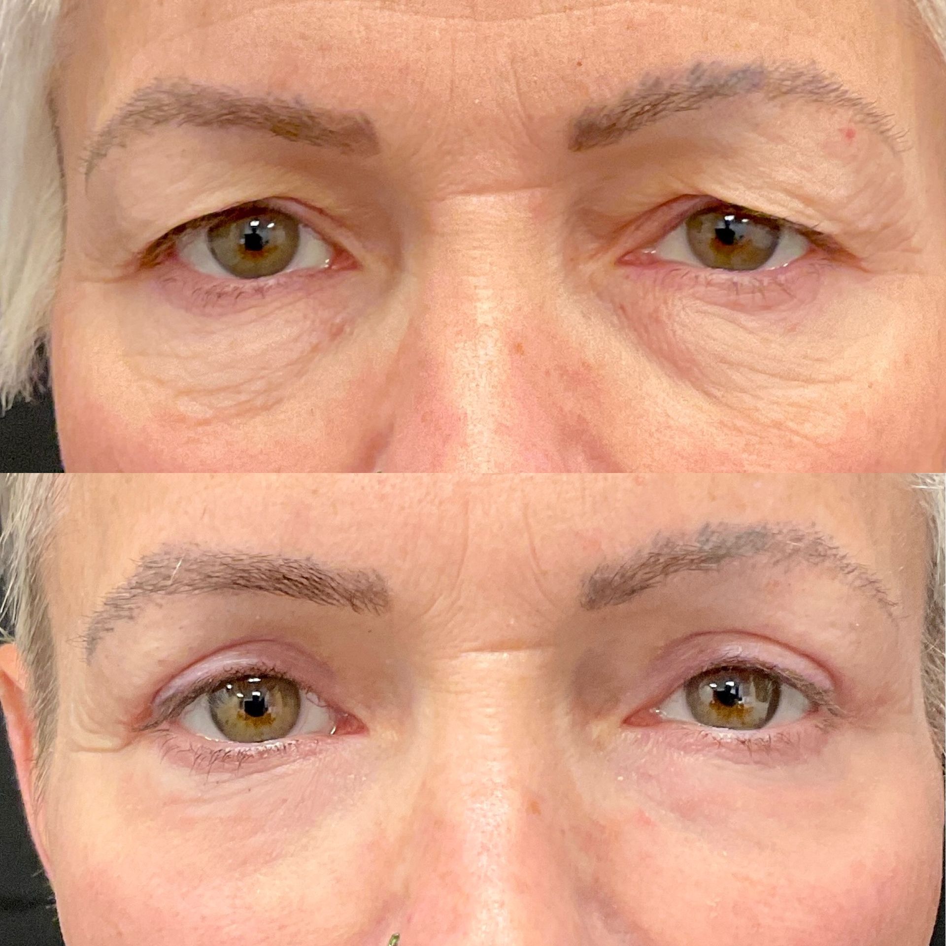 Blepharoplasty in Arvada, CO, Eyelid Surgery - Clearview Dermatology