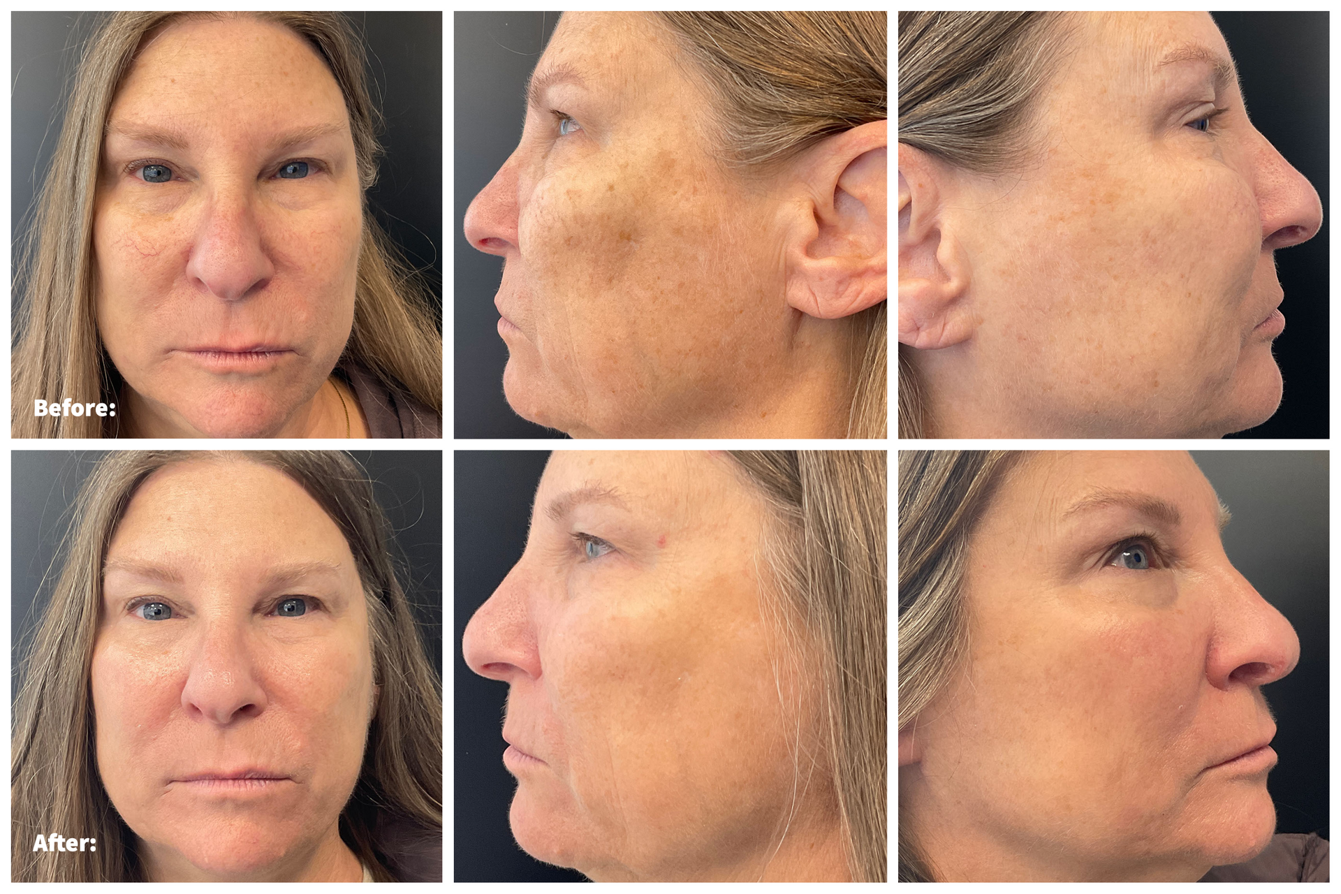 Excel V+ Laser in Arvada, CO | Improve Skin Tone and Texture