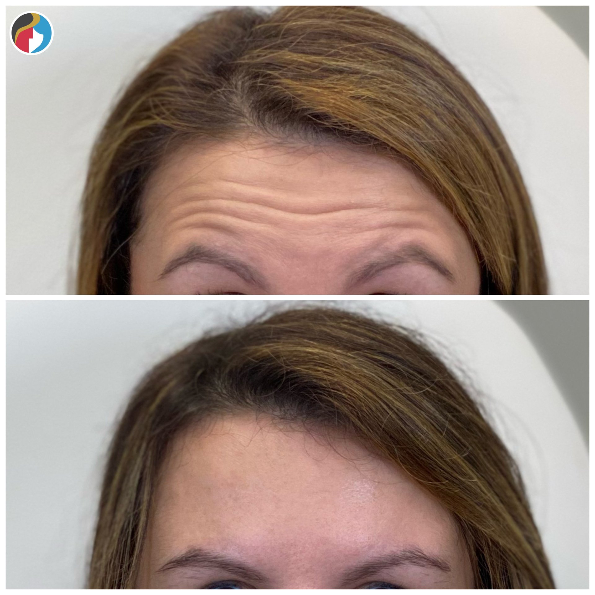 Botox Treatment | Syracuse, Albany, Rochester, New Hartford