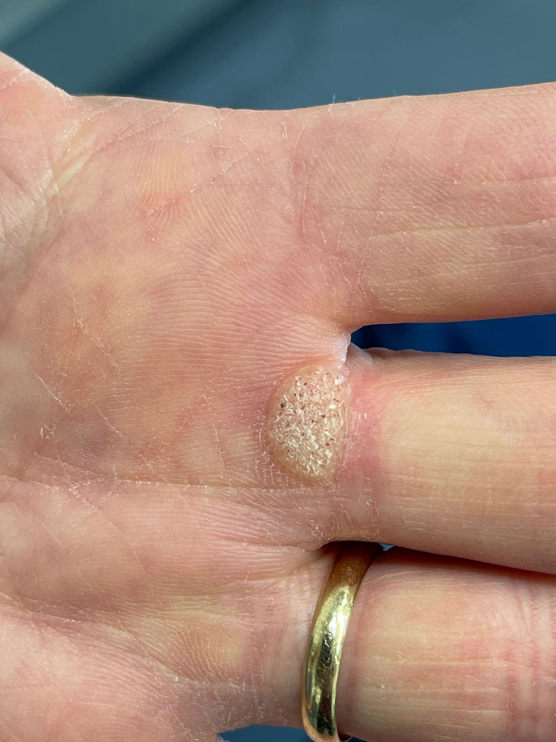 Swift Verruca Treatment - Whitley Bay | Bay Podiatry