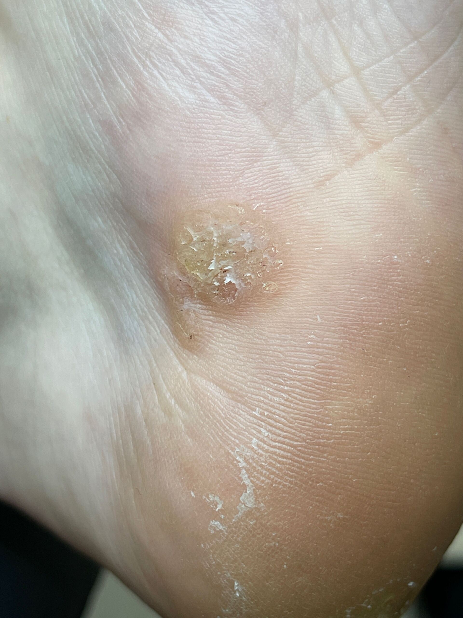 Swift Verruca Treatment - Whitley Bay | Bay Podiatry