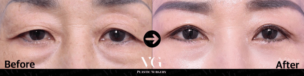 Seoul Eyelid Surgery Clinic: Best Blepharoplasty in Korea - Costs, Reviews