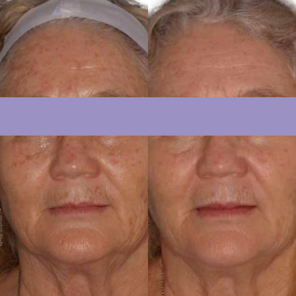 Photodynamic Therapy in Sunshine Coast | Coastal Skin & Laser