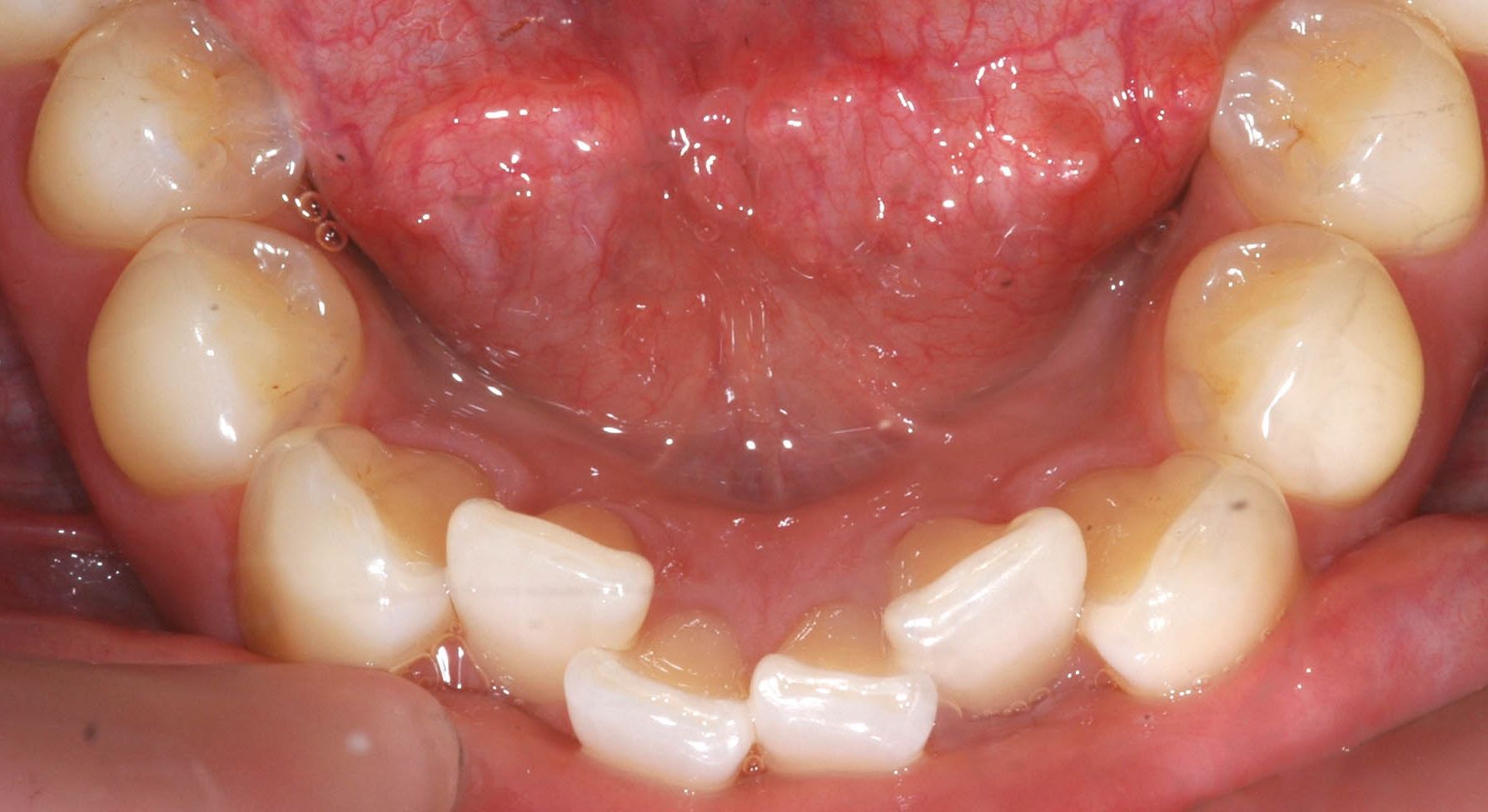 Invisalign Clear Braces | Discover Dental Wellington