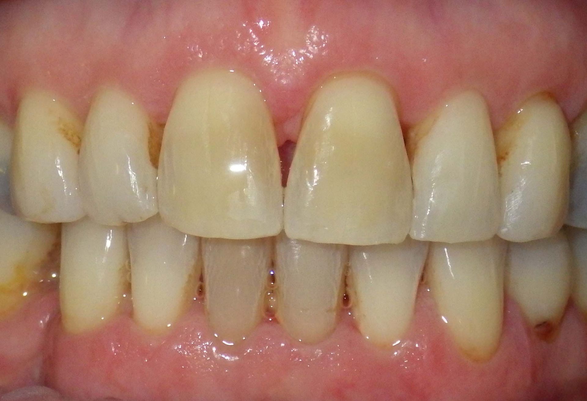 Invisalign Clear Braces | Discover Dental Wellington