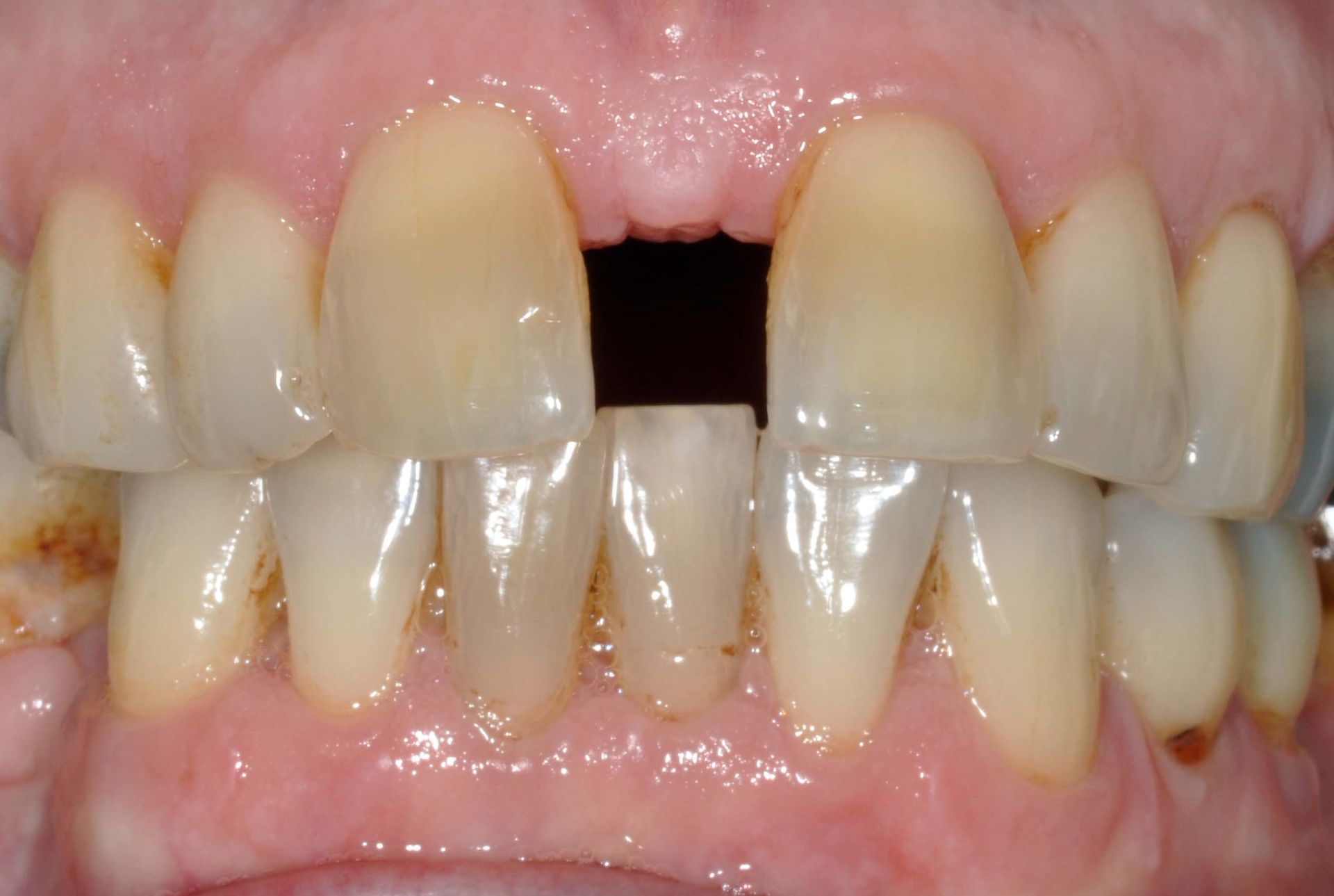 Invisalign Clear Braces | Discover Dental Wellington