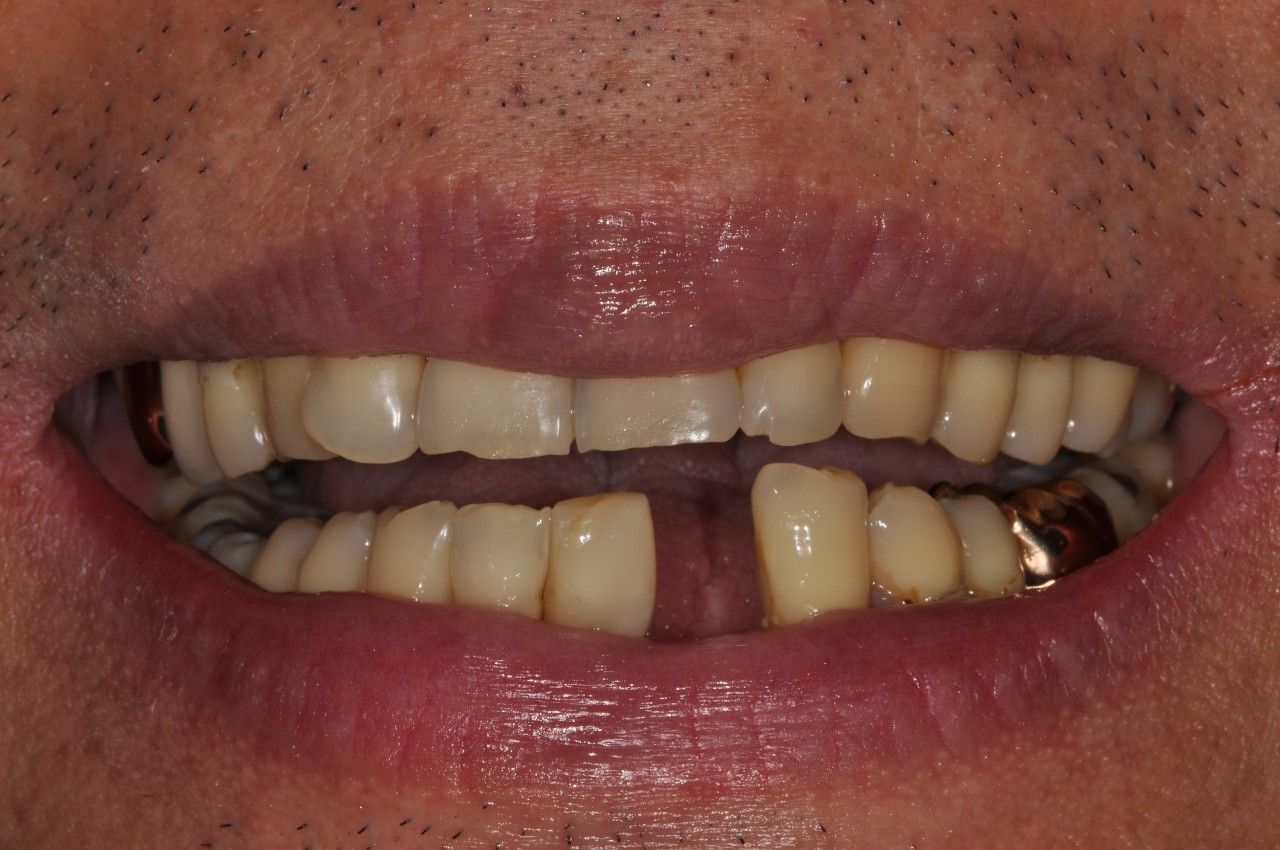 Partial Dentures | Discover Dental Wellington