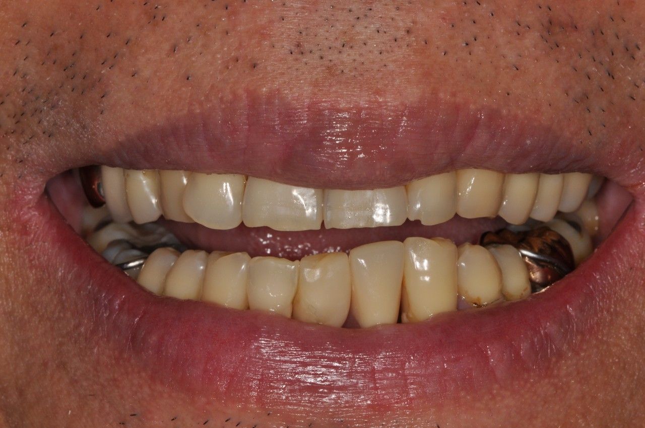 Partial Dentures | Discover Dental Wellington