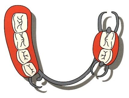 Partial Dentures | Discover Dental Wellington