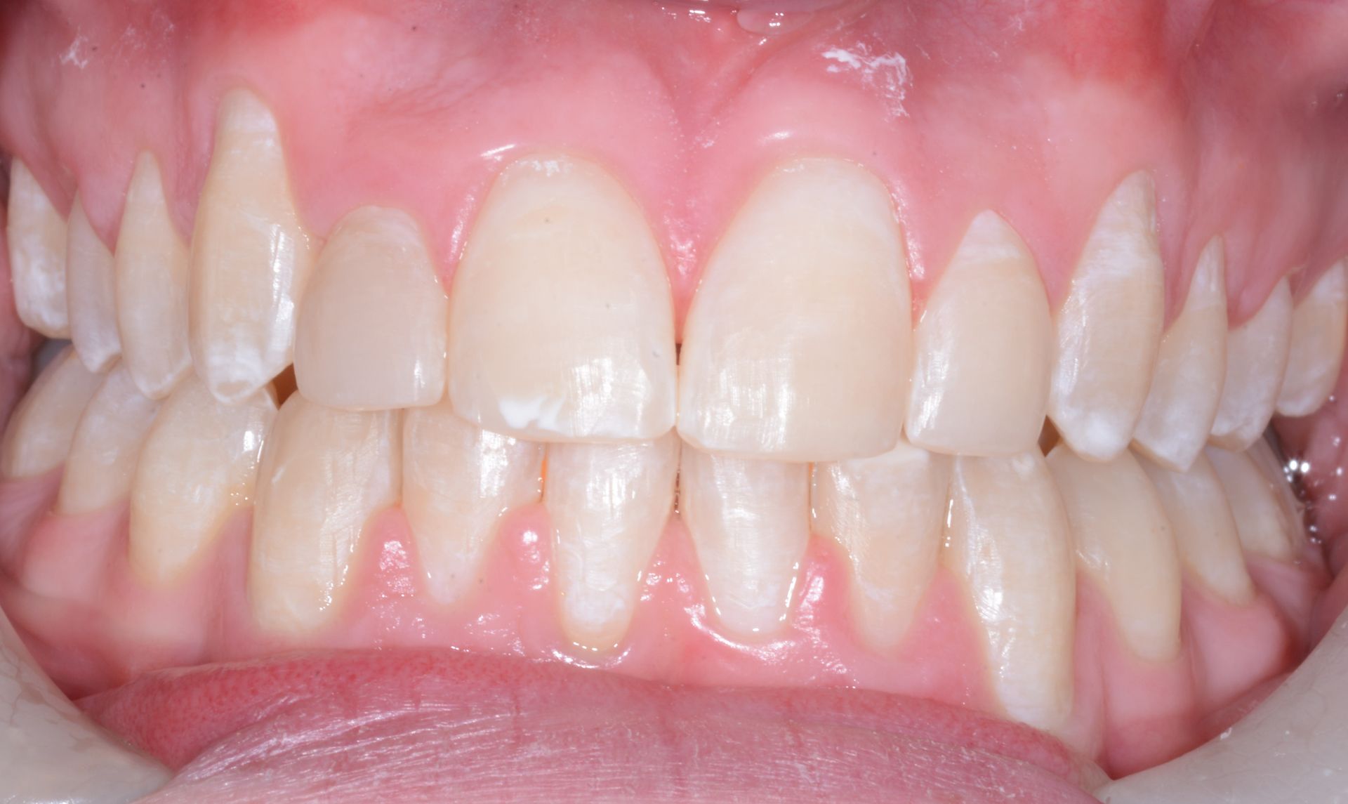 Orthodontics - Braces | Discover Dental Wellington