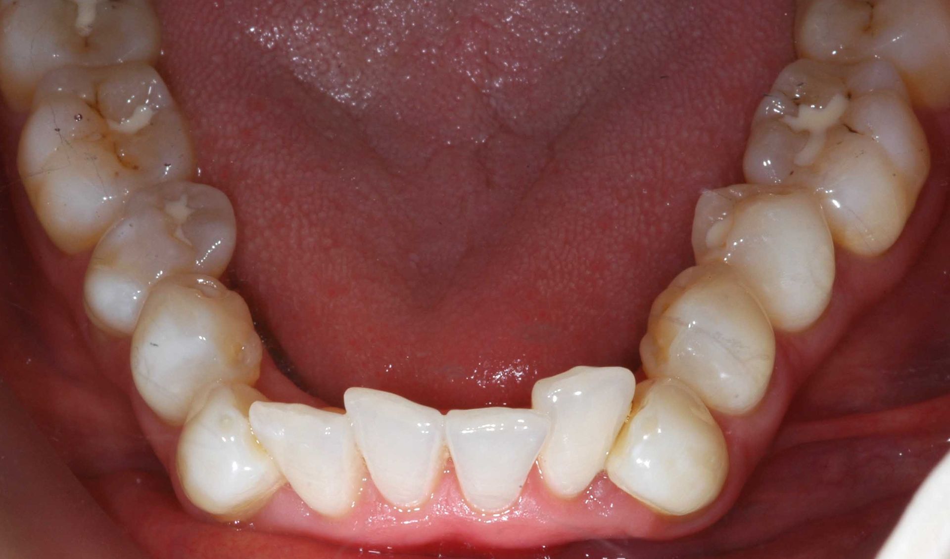 Invisalign Clear Braces | Discover Dental Wellington