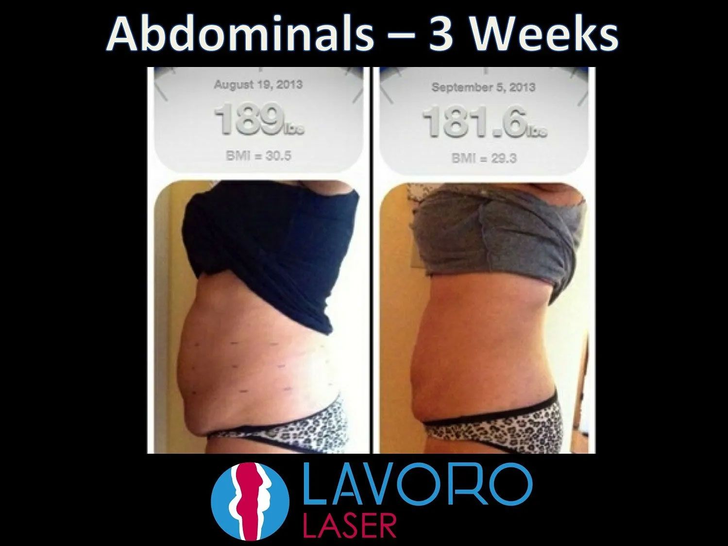 Before & After Gallery | Walnut Creek, CA | Lavoro Laser