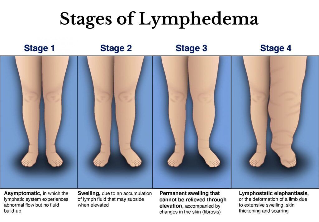 Angel Leaf Rehab & Consulting, LLC | Lymphedema