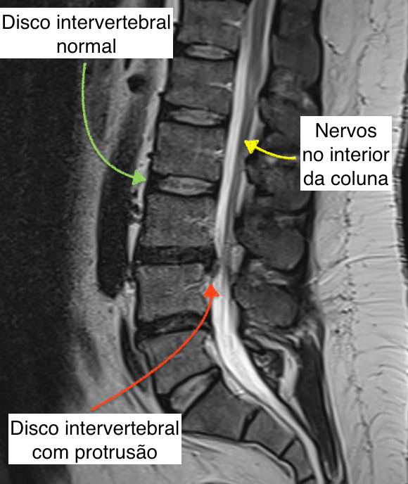 Protrusão discal: o que significa e quando se preocupar?