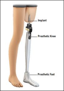 Osseointegration