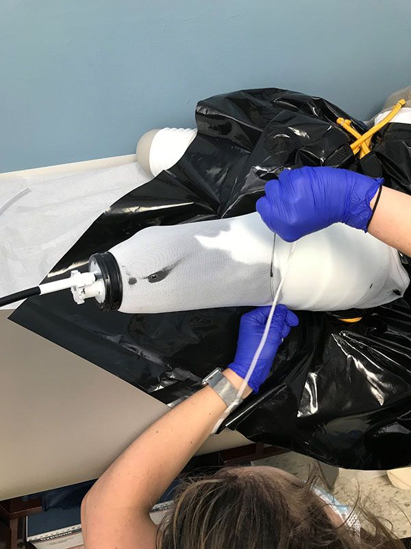 Direct Socket Leg Prosthetics | Infinite Technologies