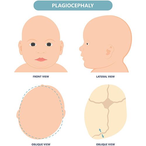 Plagiocephaly | Infinite Technologies