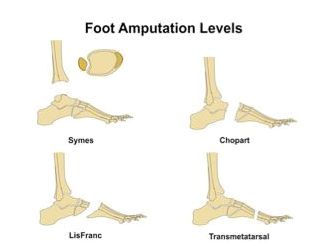 Foot Prosthetics | Infinite Technologies