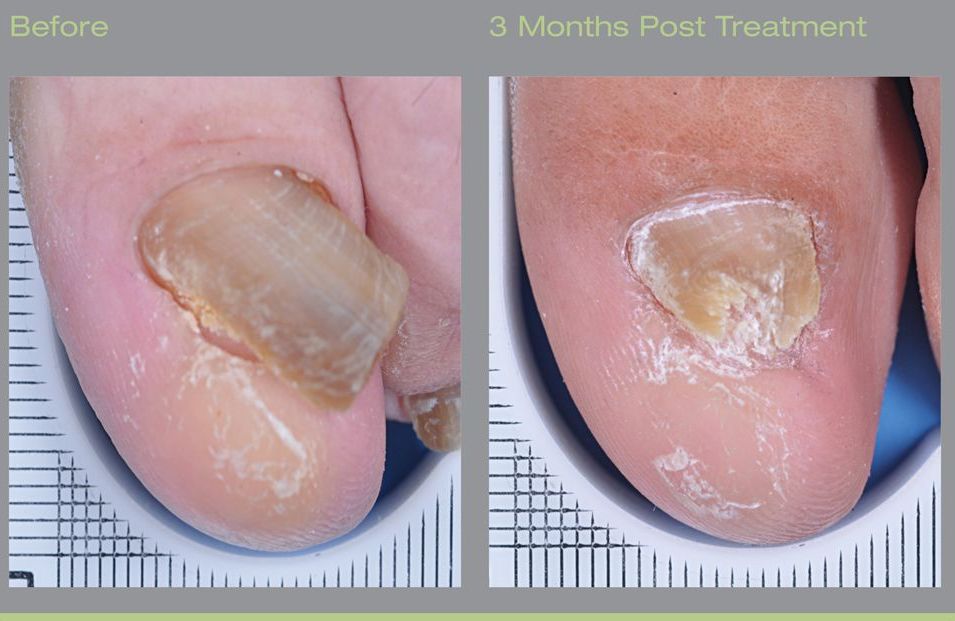 Medical Foot Care