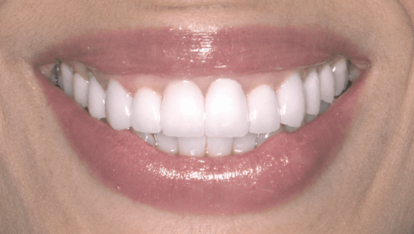 Top Smile Makeover Studio | Simply Veneers