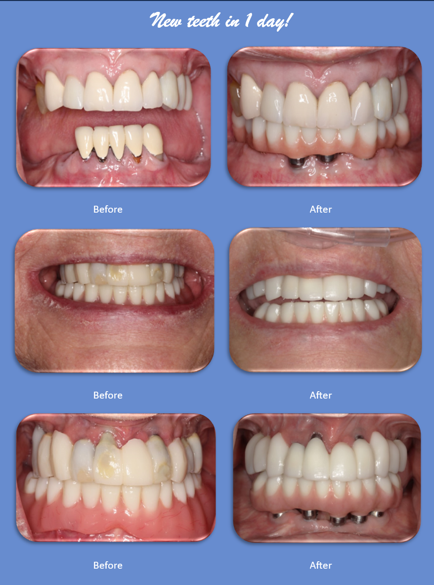 Dental Implants Experts | Auburndale, FL | Dr. Dwight