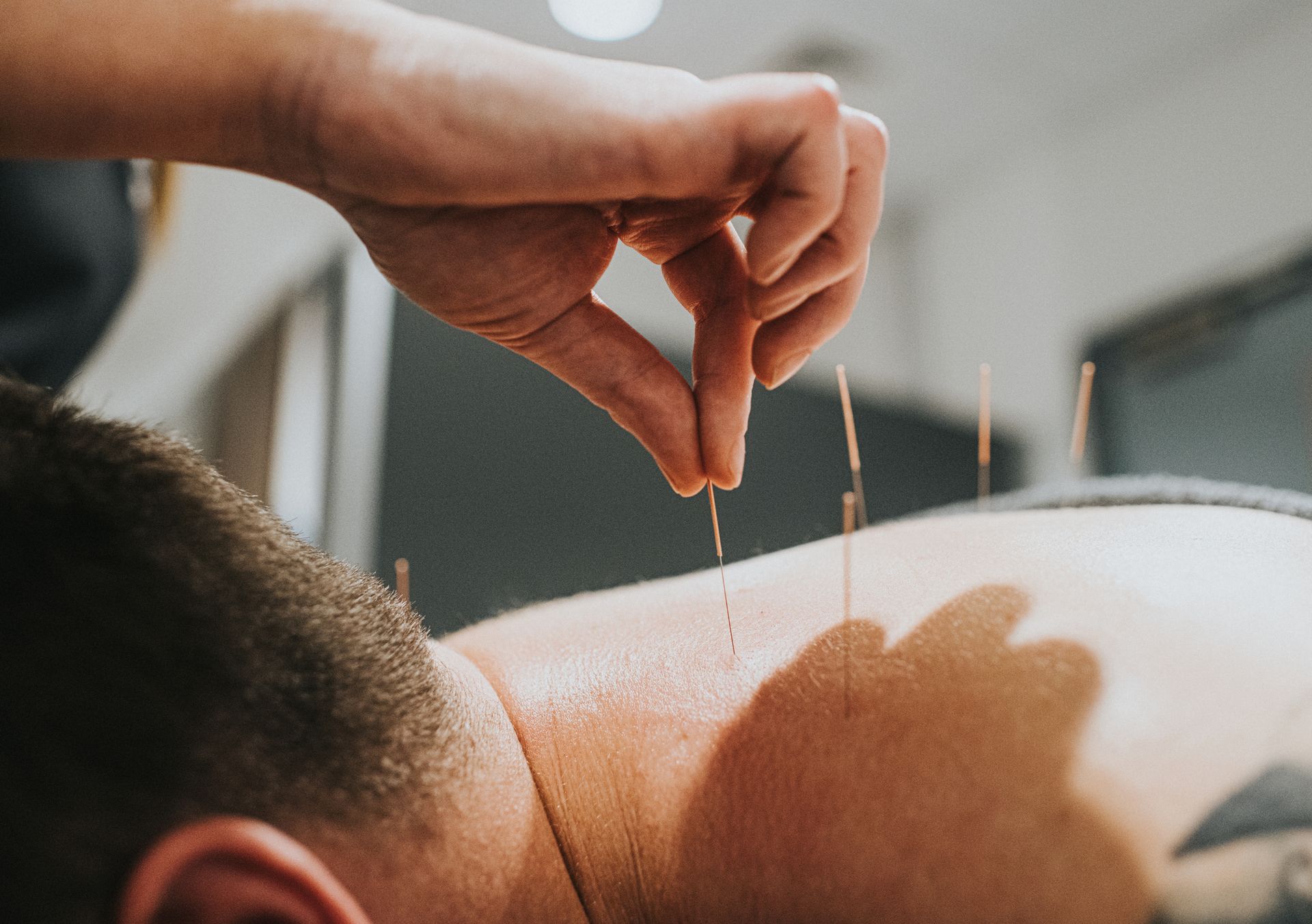 Dry Needling & Acupuncture Therapy | Brighton, SA