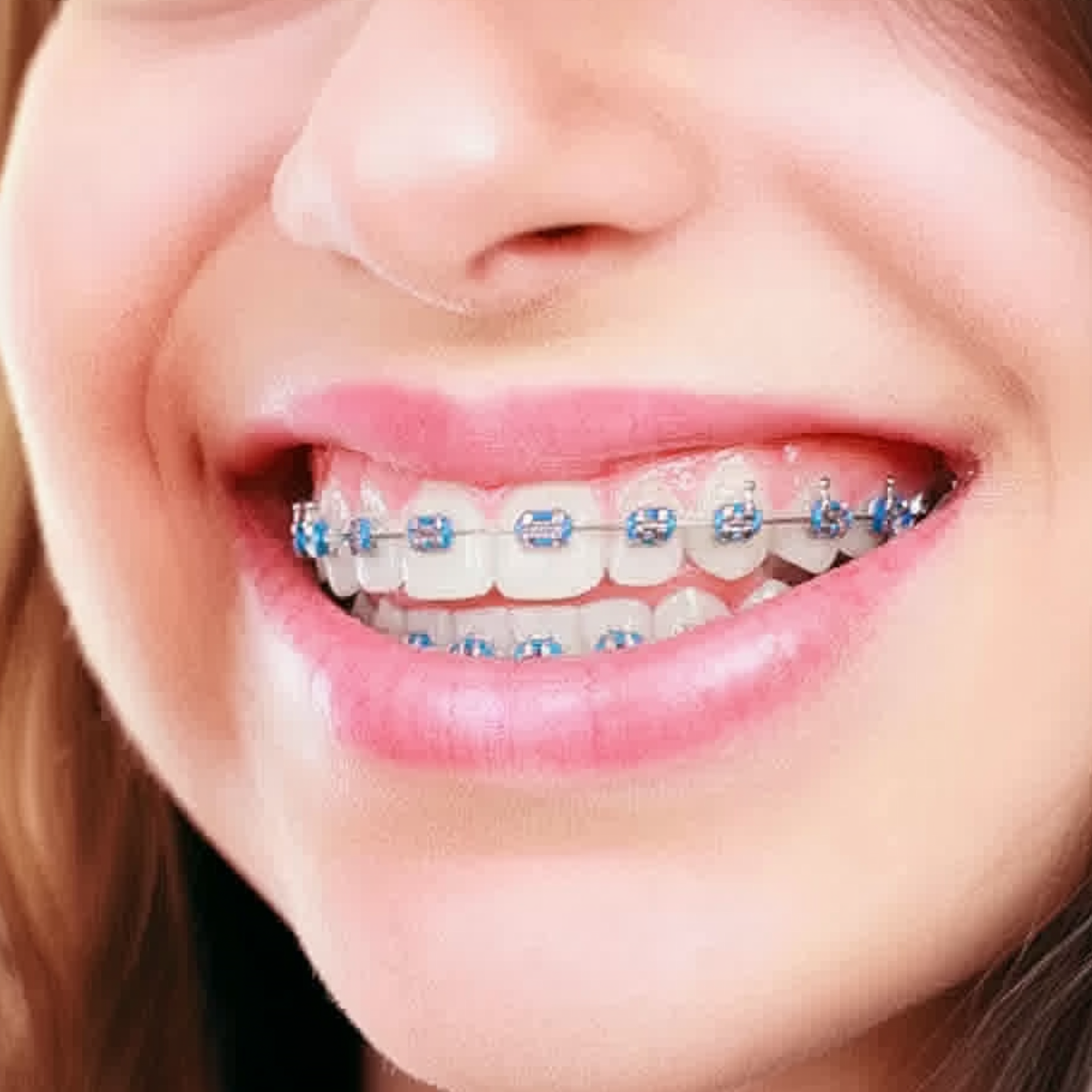 How To Choose The Best Braces Colors With Wertz Orthodontics