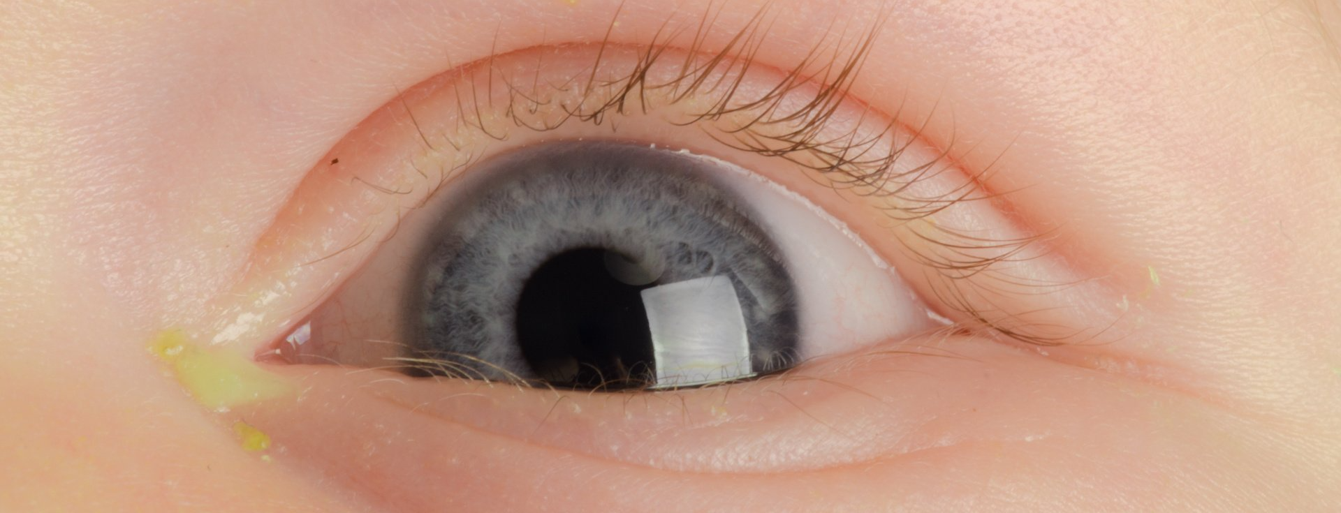 Conjunctivitis in Children: Symptoms and Treatments