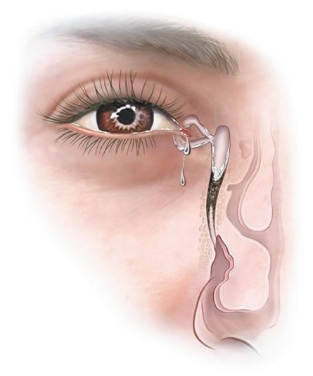 Blocked Tear Ducts | Eye Conditions | Visionary Eye Specialists