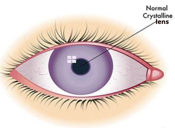 Cataracts | Eye Conditions | Visionary Eye Specialists
