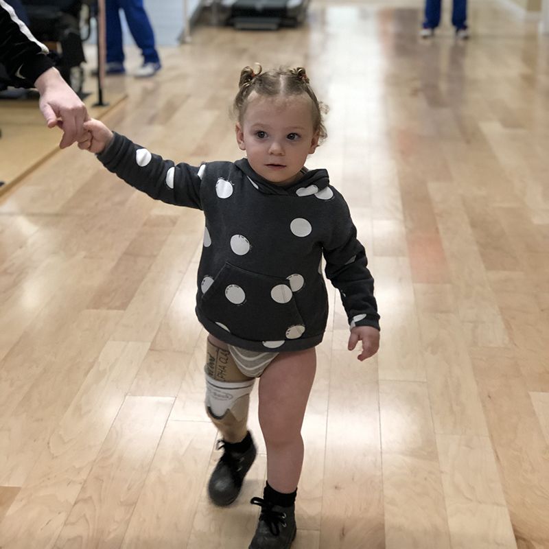 Pediatric Prosthetics Gallery | Prosthetics in Motion
