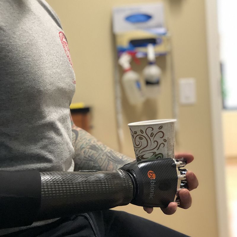 Upper Extremity Prosthetics Gallery | Prosthetics in Motion