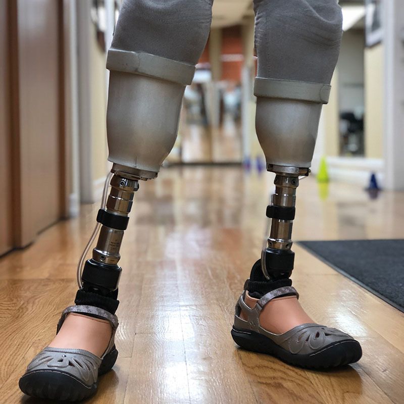 Bilateral Prosthetics Gallery | Prosthetics in Motion