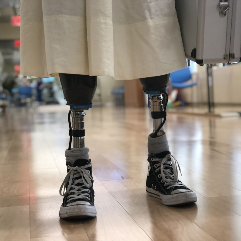 Bilateral Prosthetics Gallery | Prosthetics in Motion