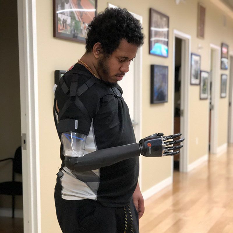 Upper Extremity Prosthetics Gallery | Prosthetics in Motion