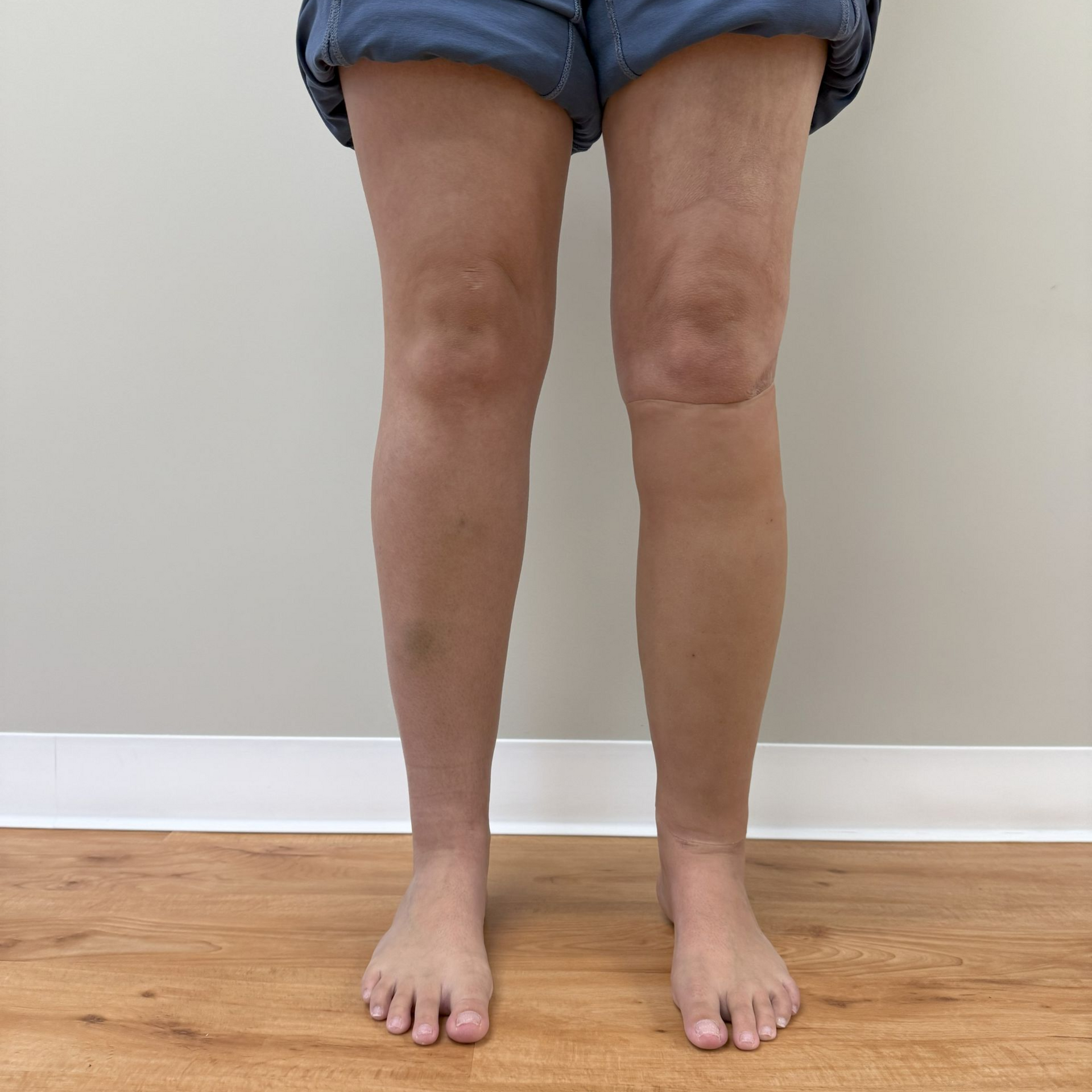 Prosthetic Silicone Skins Gallery | Prosthetics in Motion