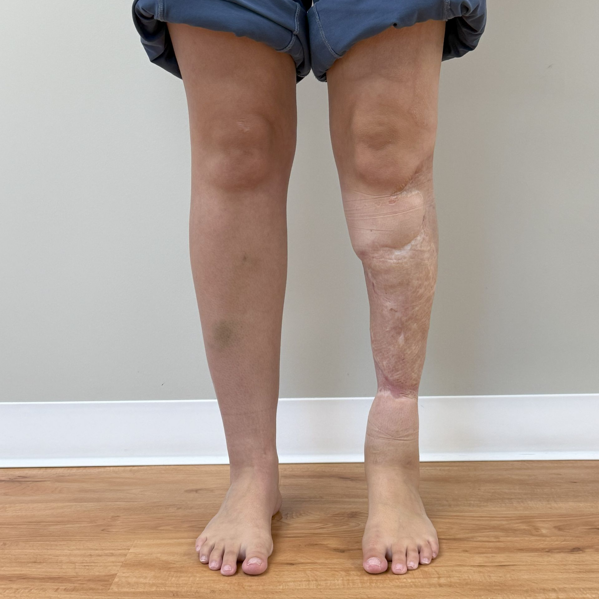 Prosthetic Silicone Skins Gallery | Prosthetics in Motion