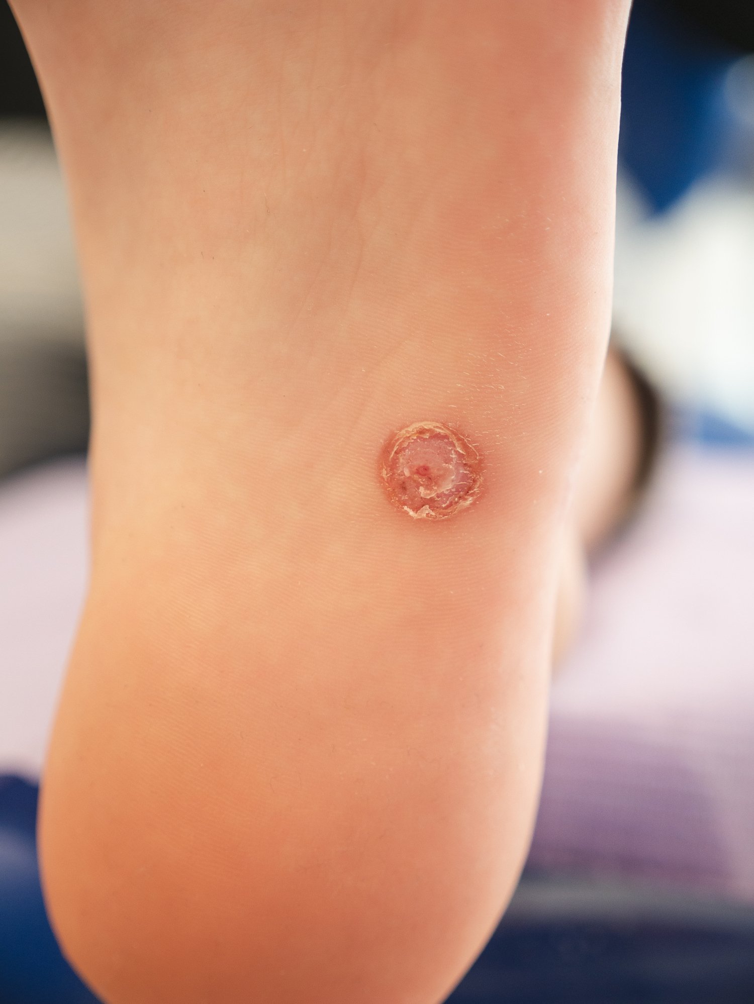 Skin Growths | Yuba City, CA | Advanced Dermatology of Northern California